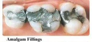 Amalgam vs. Composite Fillings: Which Is Right for You ...