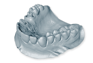 Digital Dentures: How They Work and Why You Should Consider Them ...