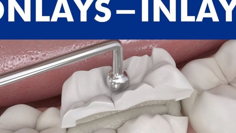 Inlays and Onlays: Restoring Teeth with Strength and Precision ...